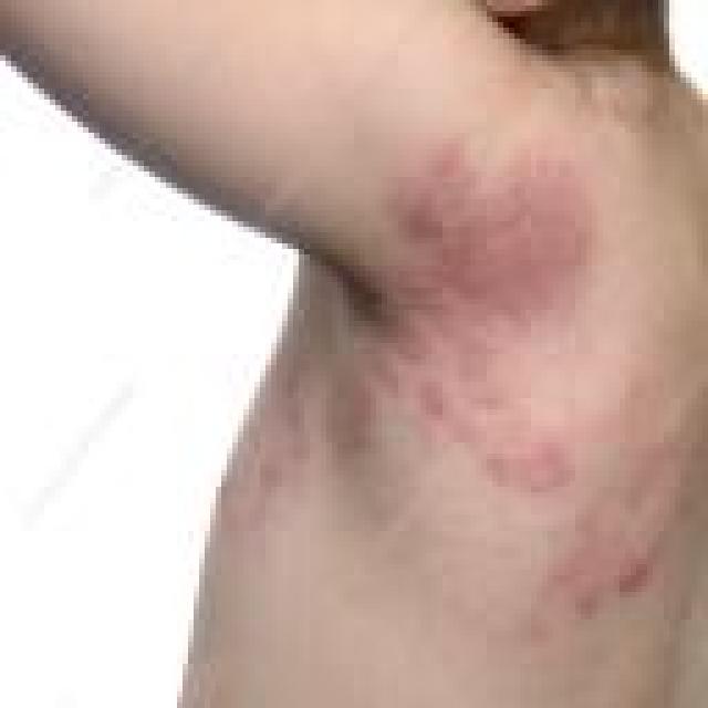 Skin Disease Detection Classification Dataset And Pre Trained Model By Icik Bos