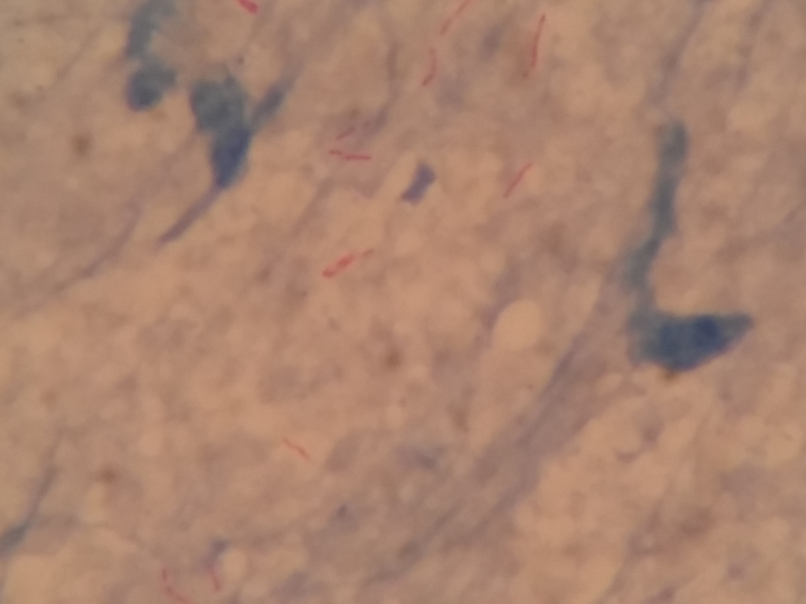 Tb Disease Dataset2 Object Detection Dataset And Pre Trained Model By Tb Disease Dataset