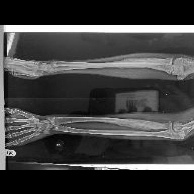 Bone Cancer Object Detection Model by Dummy