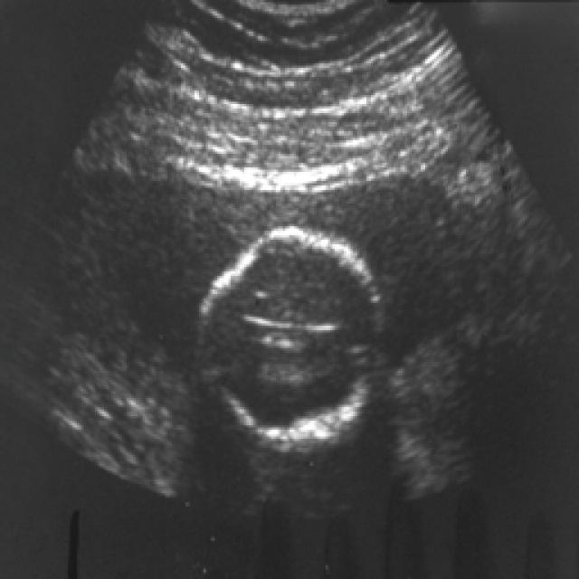fetus abnormality Object Detection Dataset by sophiafyp