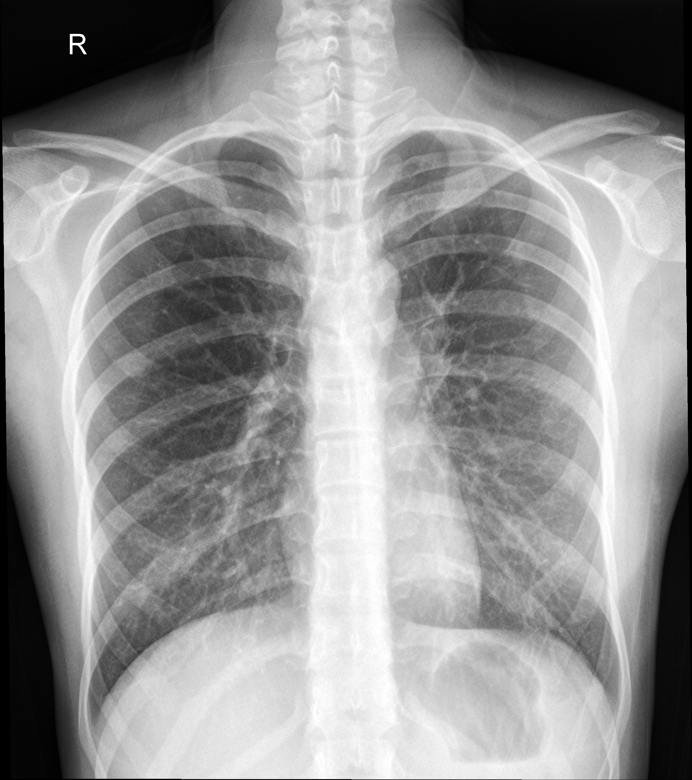 Pneumonia Detection Classification Dataset And Pre Trained Model By