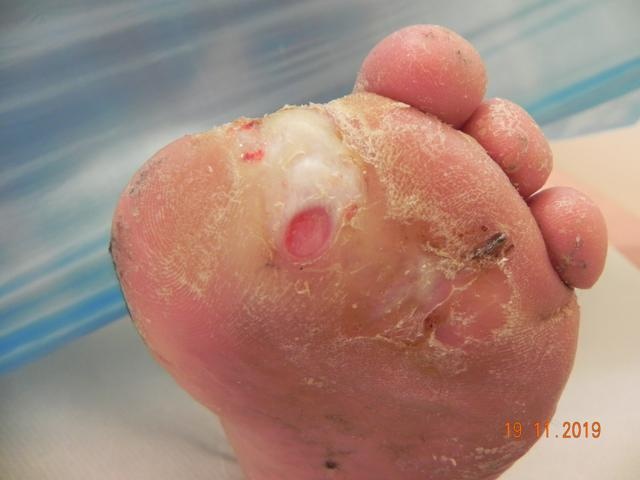 DFU Annotation Object Detection Dataset by Annotation