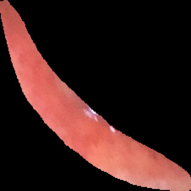 Anemia detection - Roboflow Universe Anemia detection - Roboflow Universe