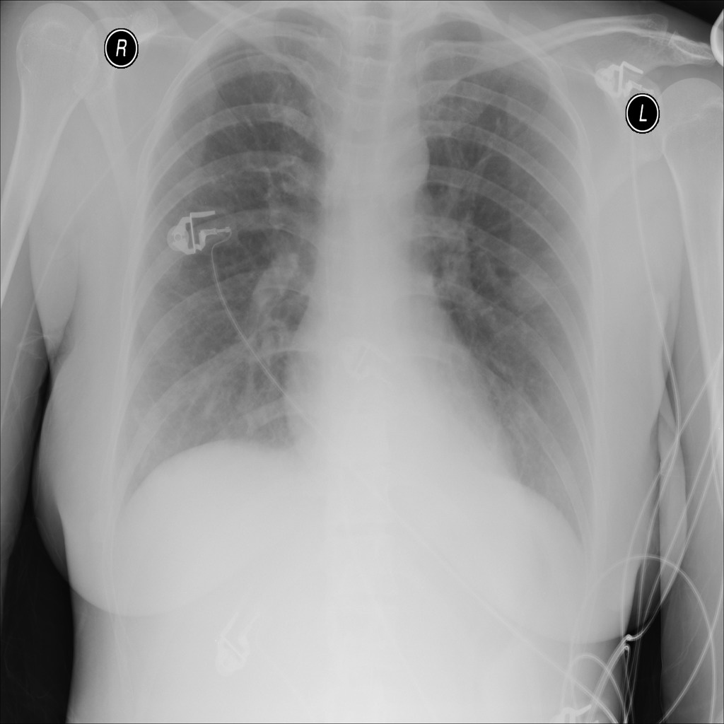Pneumonia Detection Object Detection Model by Jeets WorkSpace