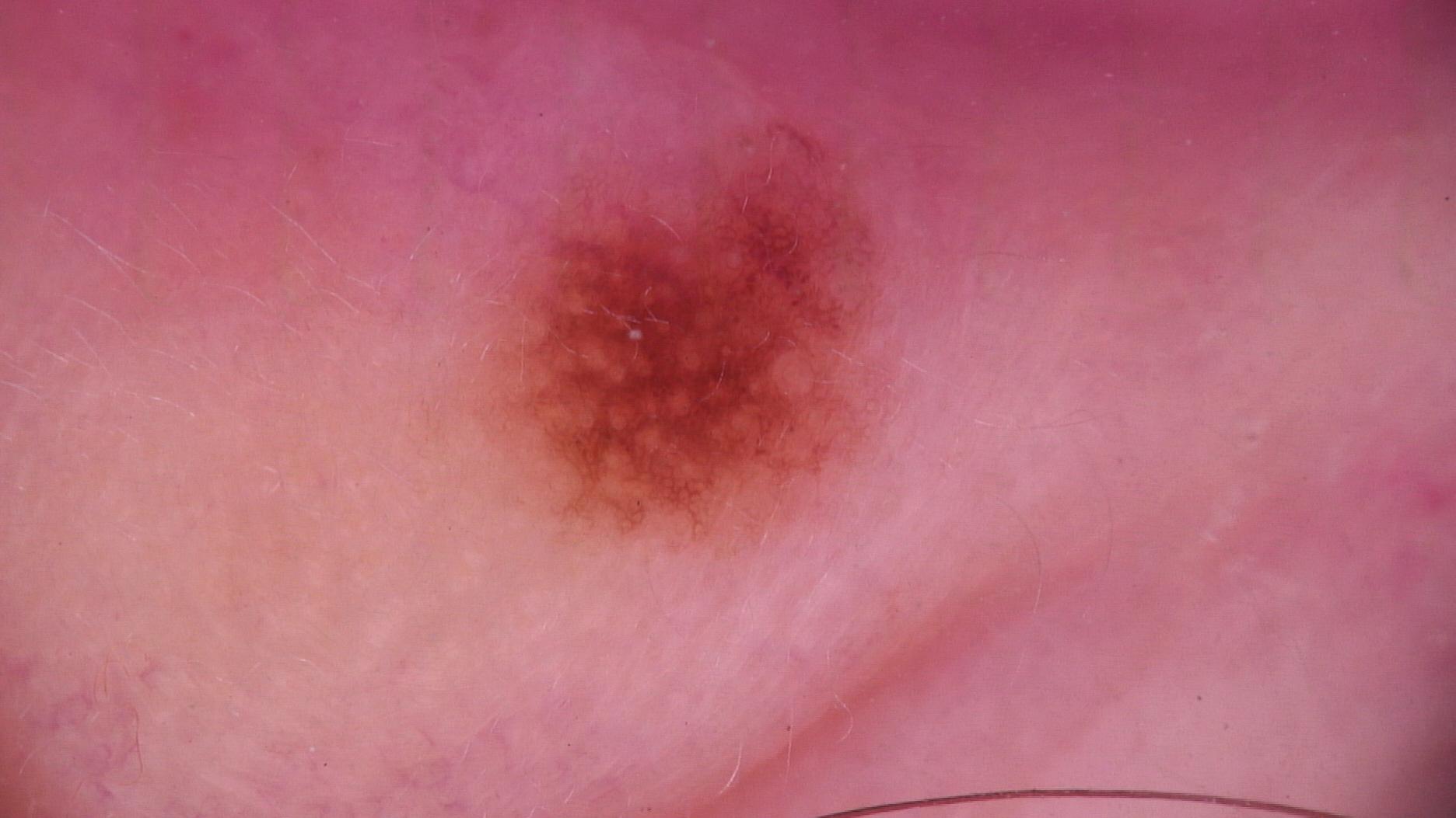 Cancer Detection Object Detection Dataset By Skin Cancer Images