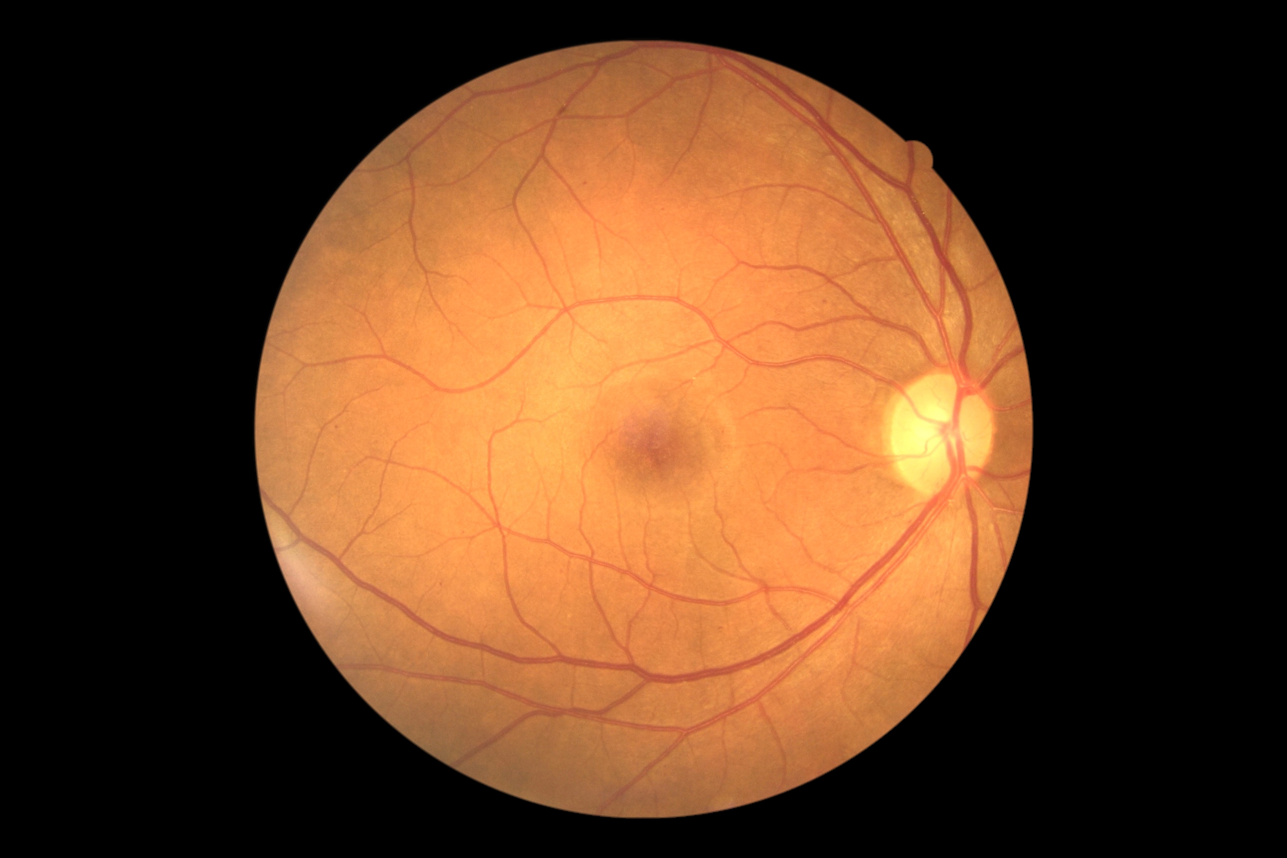 blindness detection using ddr dataset Object Detection Dataset by final project