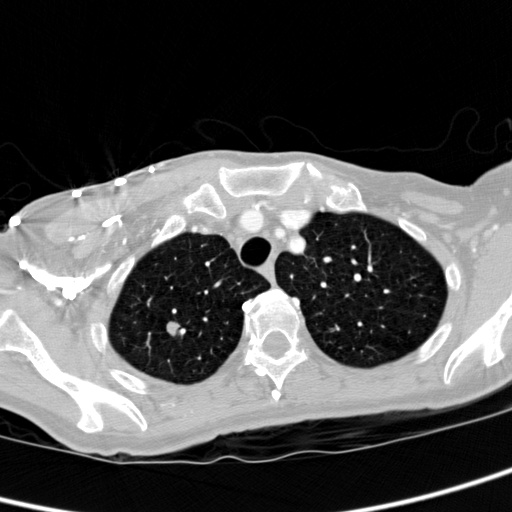 Lung Nodule Detection Object Detection Dataset And Pre Trained Model By Ss