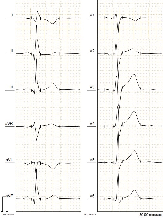 ECG Classification Model by TESTEC