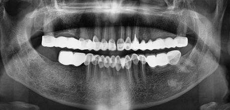 Genral-n-caries1 Object Detection Dataset by jeddah university