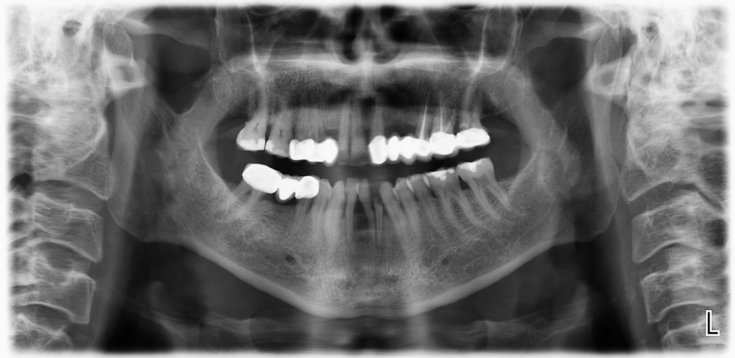 Our Signs of caries(balance) Object Detection Dataset by jeddah university