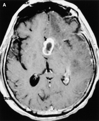tumor Instance Segmentation Dataset and Pre-Trained Model by Brain tumor