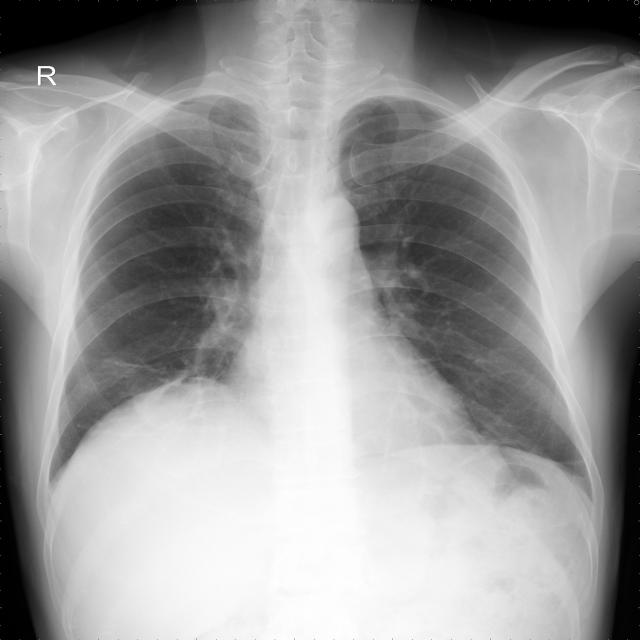 lung Object Detection Model by rp