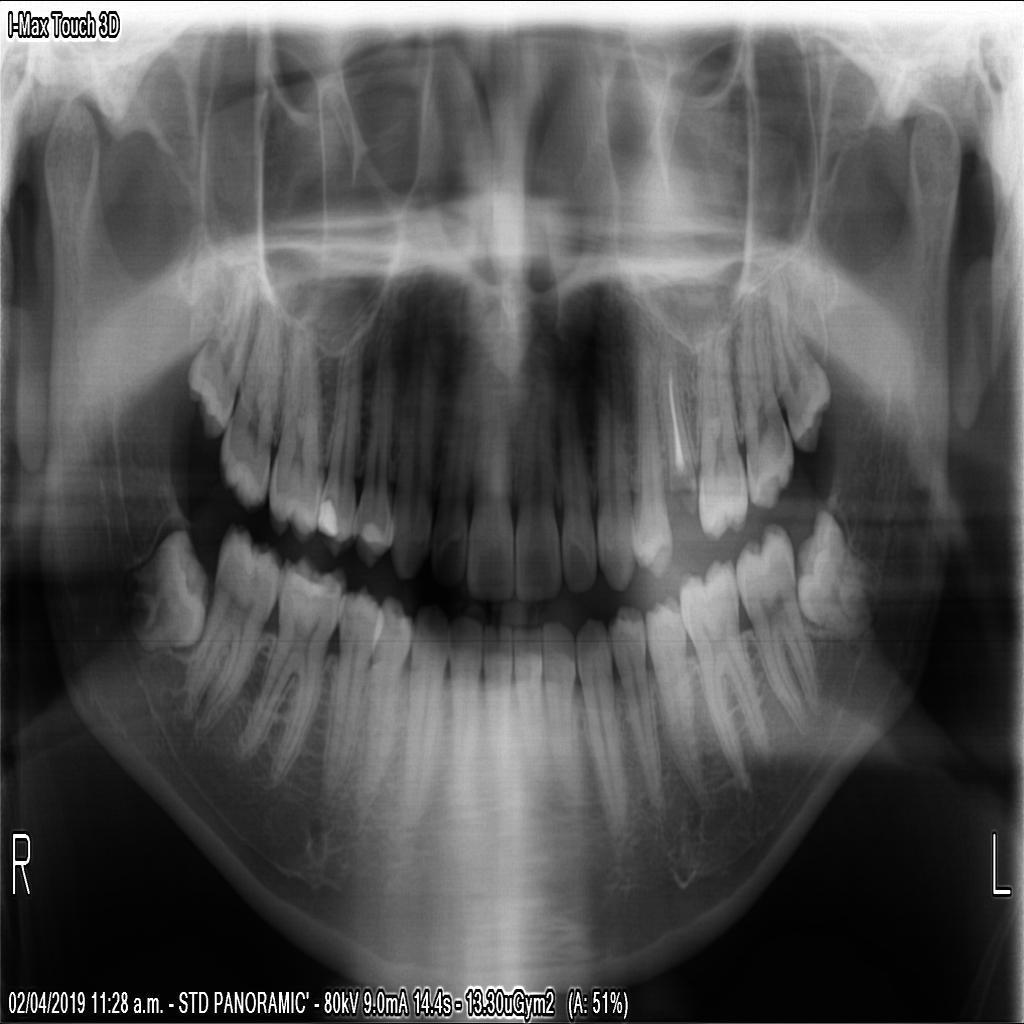 INDIVIDUAL TEETH LABELLING Instance Segmentation Model by PROJECT 1