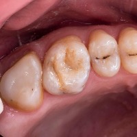 CARIES DETECTION FYP - Roboflow Universe