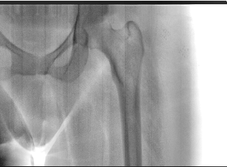 femur Instance Segmentation Instance Segmentation Dataset by spine annotation