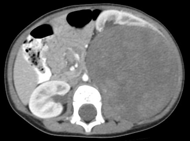 Wilms Tumor Classification Model by Miniproject