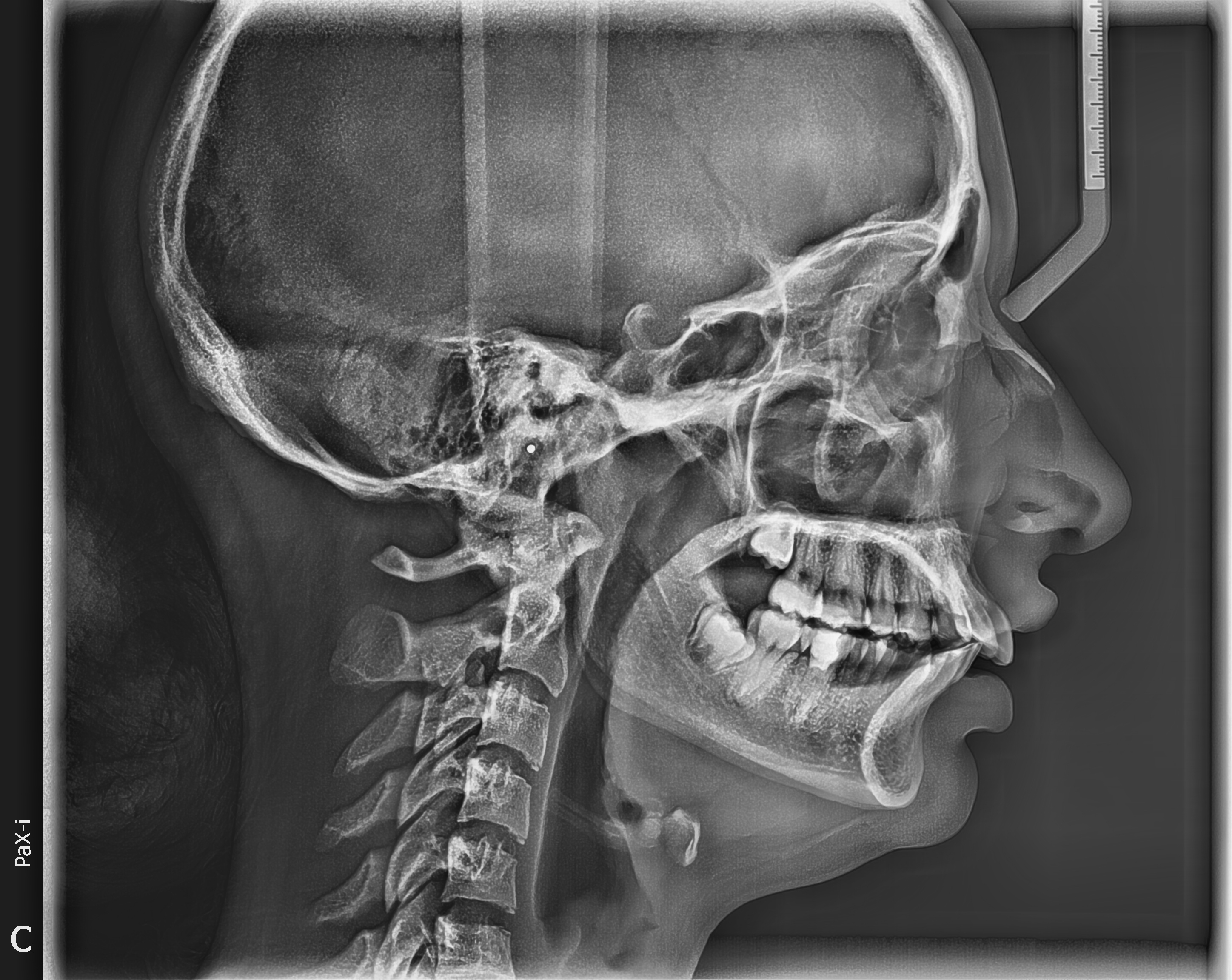 Cervical Vertebral Dataset4 Object Detection Dataset by AAST