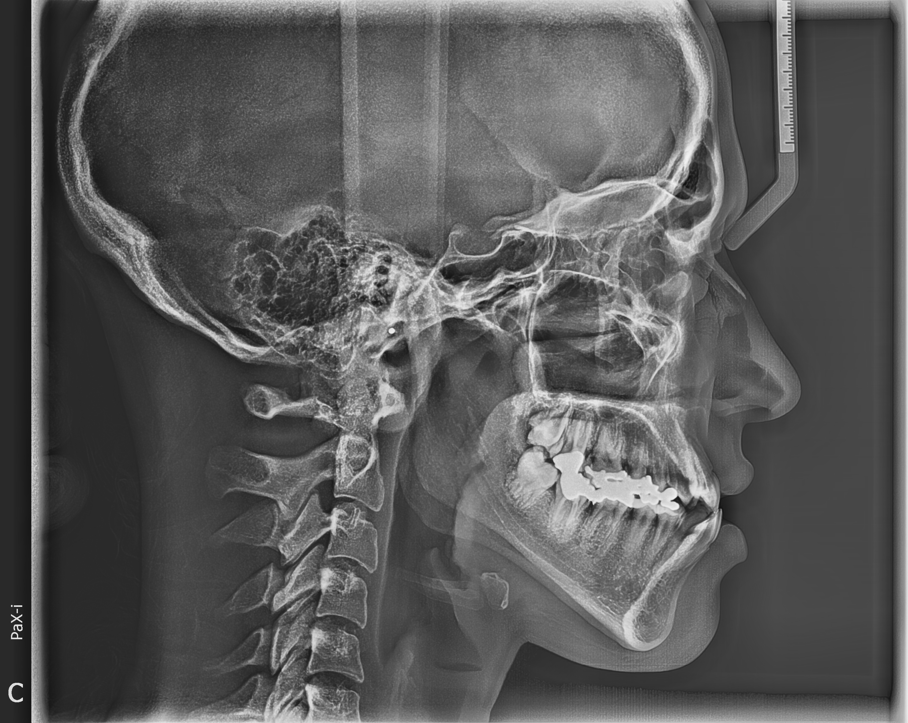 Cervical Vertebral Dataset5 Object Detection Dataset by AAST