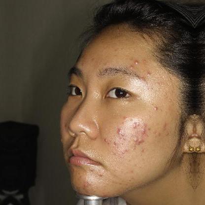 How to Use the Acne Detection Object Detection API