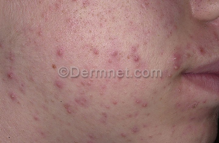 Skin Disease Detector Object Detection Dataset by BitCamp