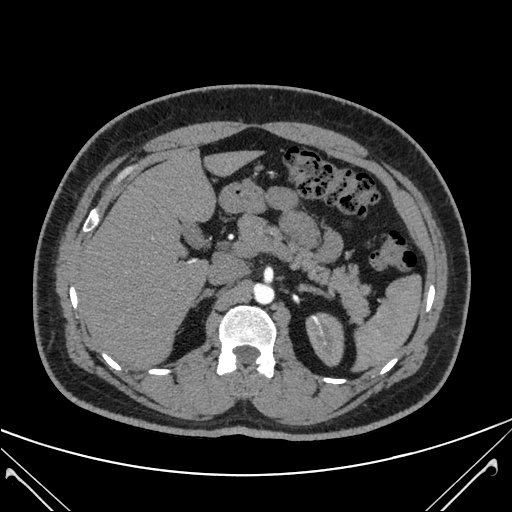 Kidney Tumor Detection Object Detection Model by Science Fair