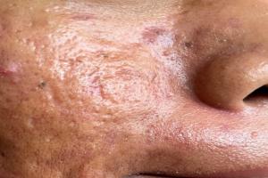 oilyness detection Object Detection Dataset and Pre-Trained Model by Work