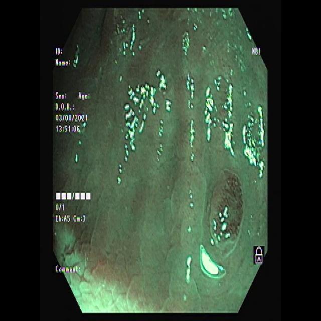 own polyps detection Object Detection Dataset and Pre-Trained Model by ...