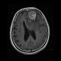 NeuroScan - Roboflow Universe