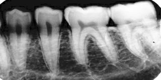 Dental Instance Segmentation Model by Pichayut Peerasathien