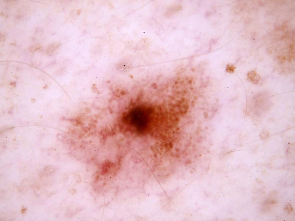 skincancer (skincancer-igsv7) - Roboflow Universe