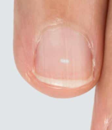 leukonychia Object Detection Dataset by Healthy Nails