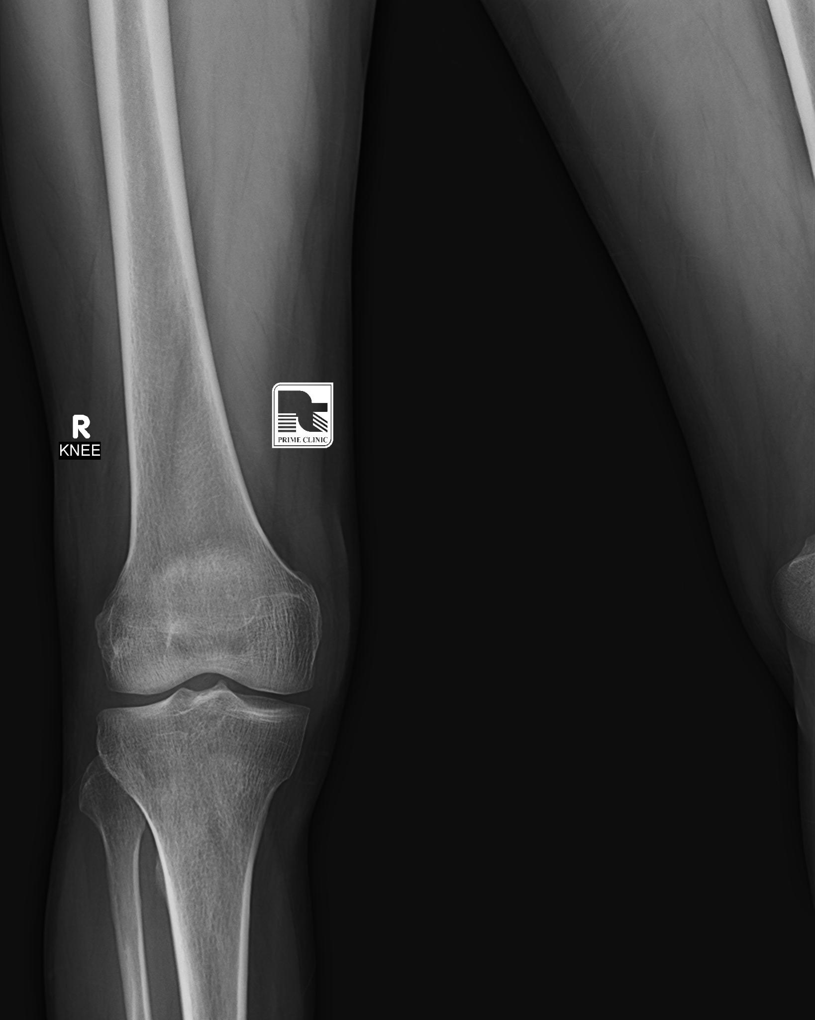 Bone fracture Classification Dataset by ej