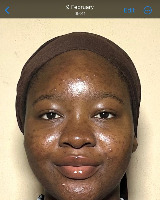 CLEO Know Your Skin - Roboflow Universe