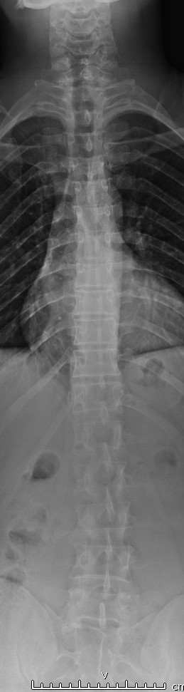 spine Classification Dataset by Eulji university