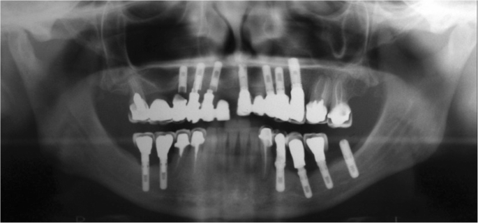dental Object Detection Dataset by tasmiamoon12@gmail.com