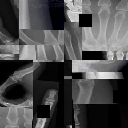 four Object Detection Dataset by bone fracture