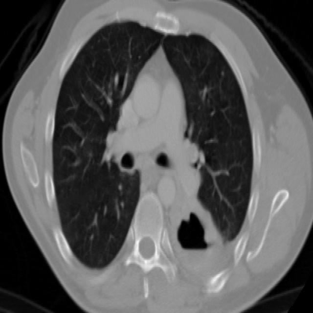 lung_cancer Classification Dataset by REVA University