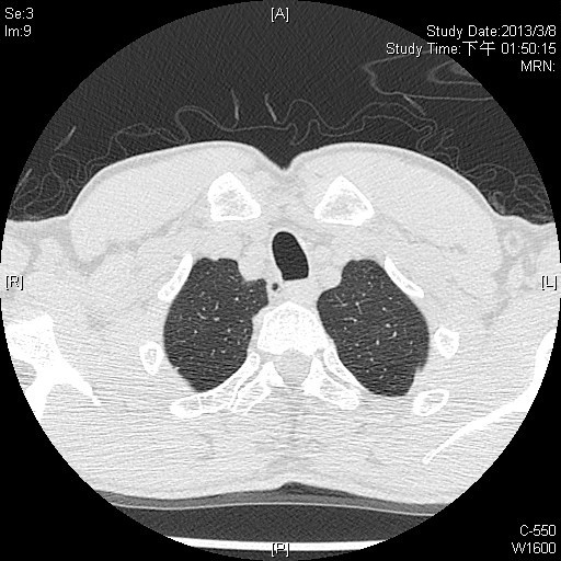 Lung_Segmentation Object Detection Dataset by CGMH