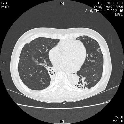 L_Lung_Instance_Segmentation Instance Segmentation Dataset by CGMH L_Lung_Instance_Segmentation Instance Segmentation Dataset by CGMH