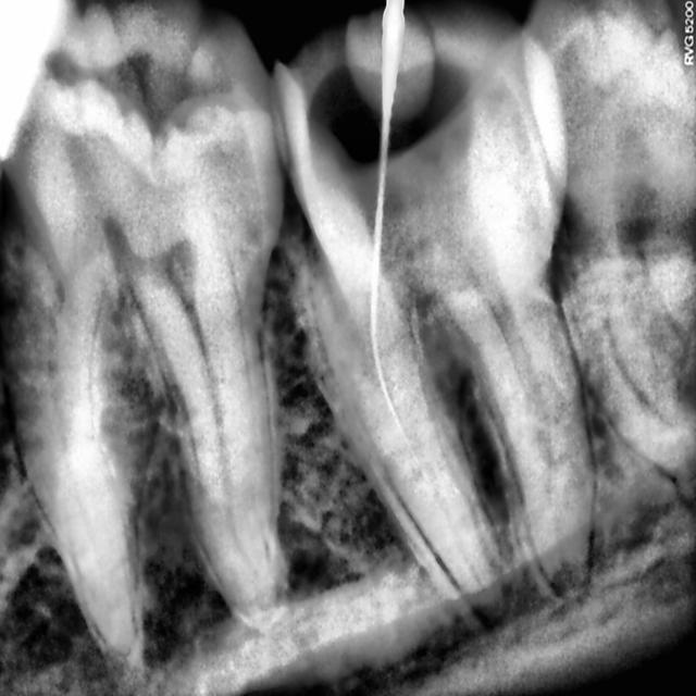 Assignment Detection Dental Object Detection Dataset By Infotsav