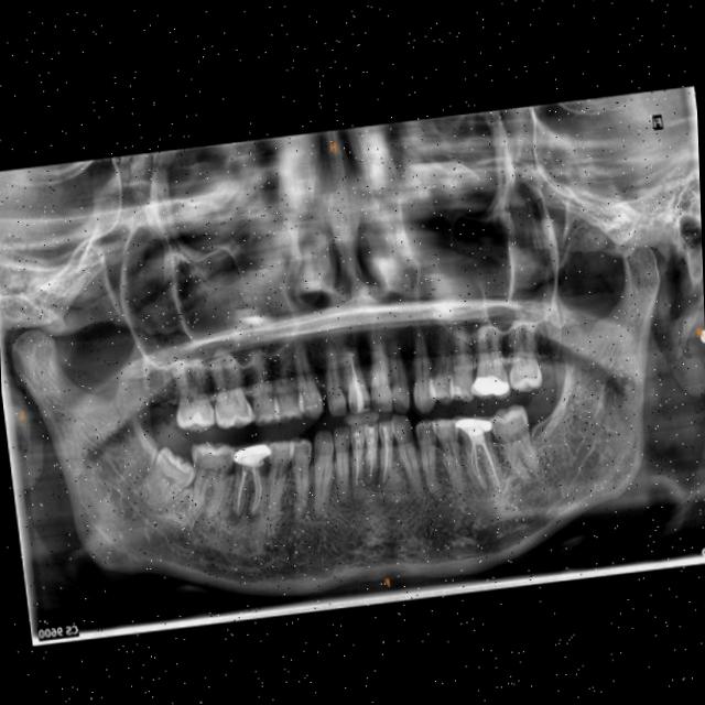 Tooth process detection Object Detection Model by Mustafa Glsoy