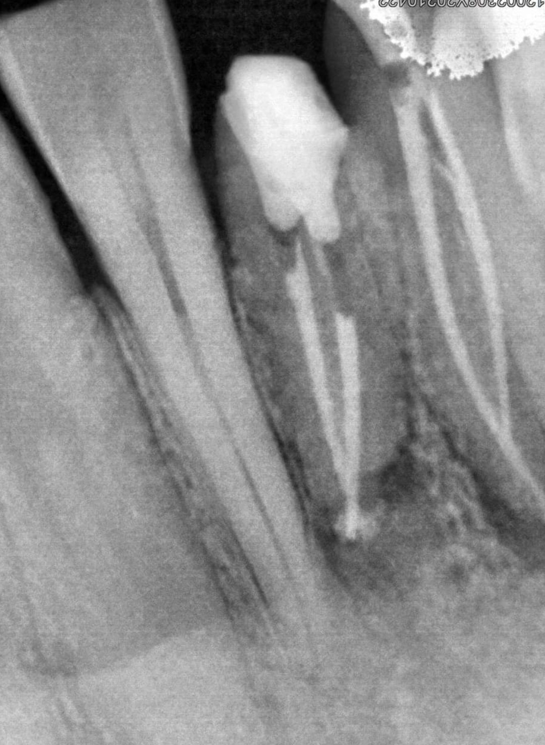 Endodontic Failure Object Detection Dataset by Shahariar Anu