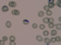 Malaria classification - Roboflow Universe
