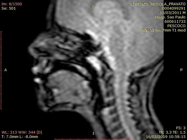 Vocal Tract Segmentation Instance Segmentation Dataset by Vocal Tract Detection Segmentation