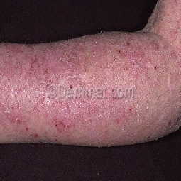 Eczema V2 Classification Model by Eczema Dataset