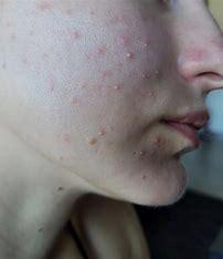 Acne Classification Model by Eczema Dataset