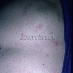 Ezcema Classification Model (v1, 2025-03-31 12:44pm) by Eczema Dataset