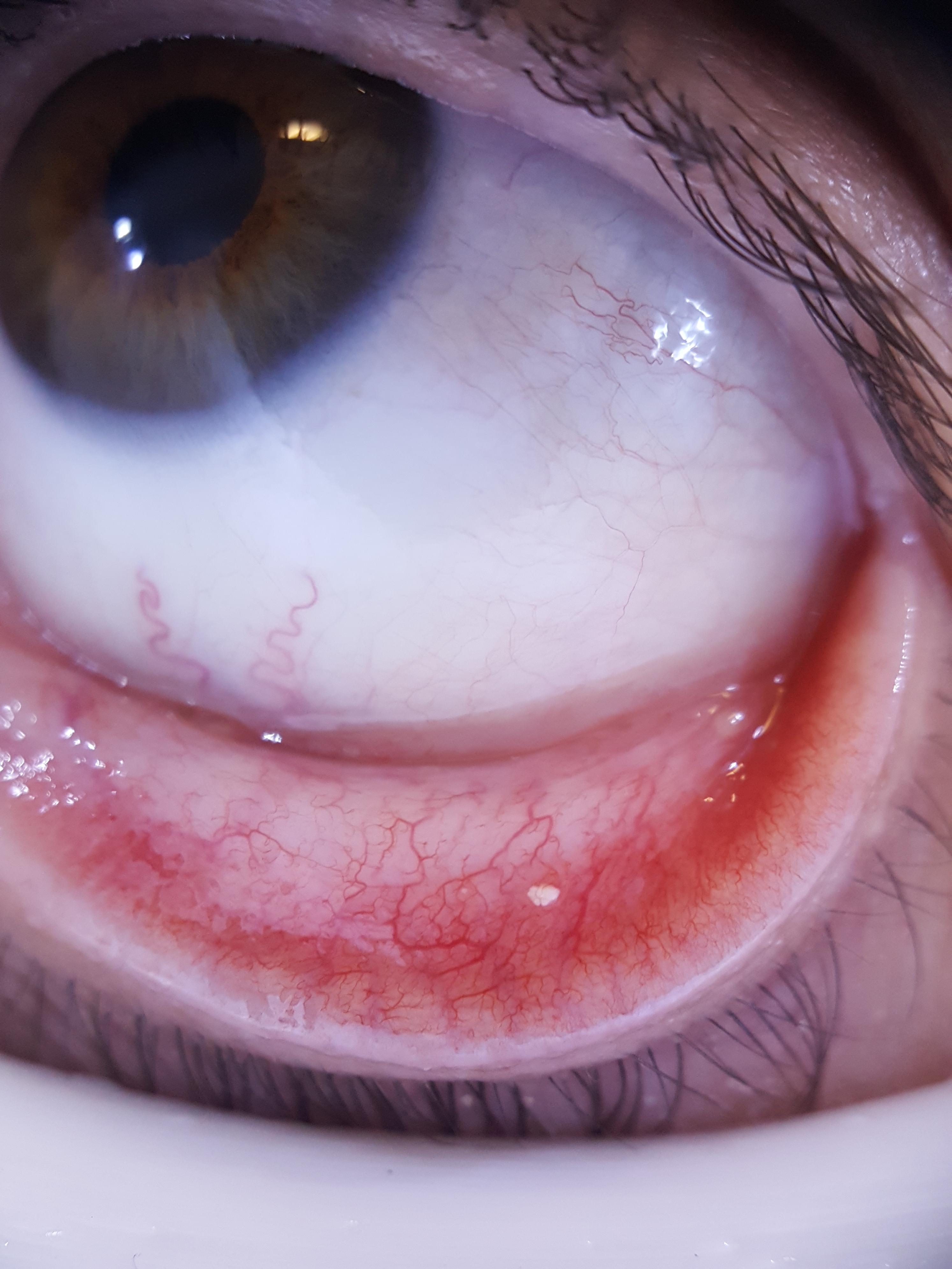 Conjunctiva Segmentation Instance Segmentation Dataset And Pre Trained Model By Tayyyy