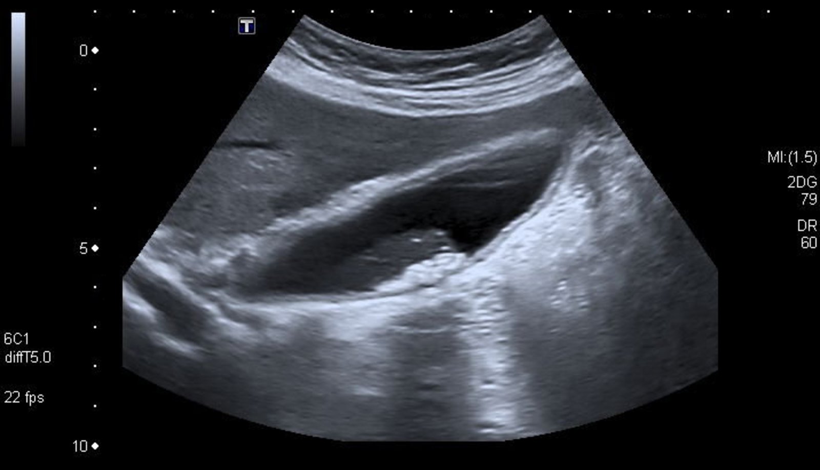 gallbladder ultrasound scans Object Detection Dataset (v1, 2023-02-05 8 ...