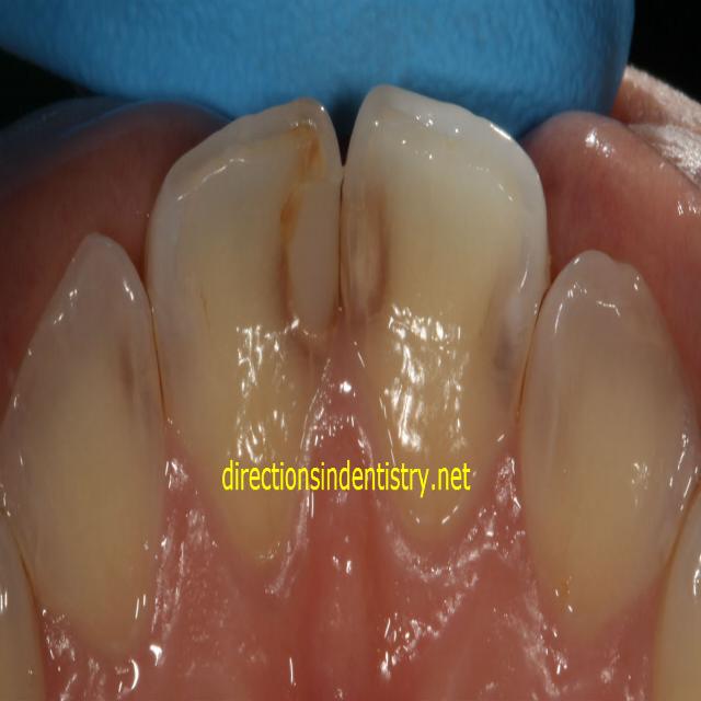 Cavity Detection Object Detection Dataset And Pre Trained Model By Vsa1